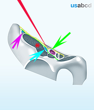 2 - Anatomy of the genitofemoral nerve - USabcd