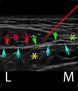 Rectus Sheath Block